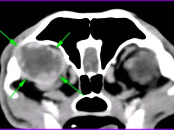 Ablation d'une tumeur épithéliale rétro-bulbaire par orbitotomie ...