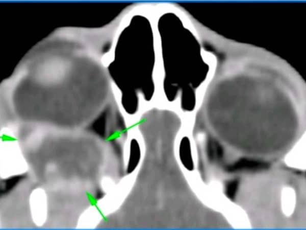 Ablation d'une tumeur épithéliale rétro-bulbaire par orbitotomie ...